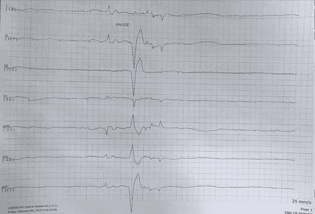 A Heart-Stopping Tale of a Simple Arm Movement. A Tragic Consequence of ...