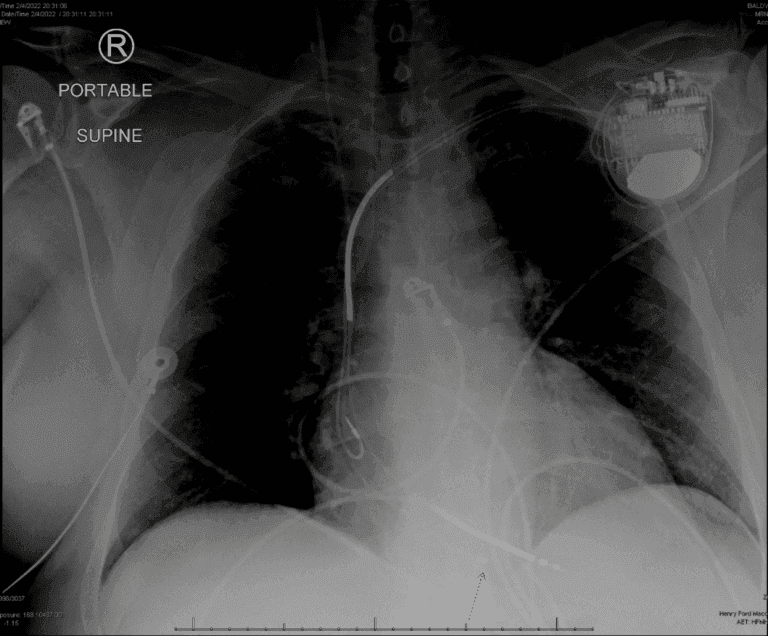 A Heart-Stopping Tale of a Simple Arm Movement. A Tragic Consequence of ...