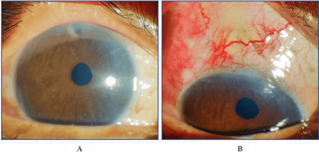 Uniocular Primary Open Angle Glaucoma: An Unusual Case Report from ...