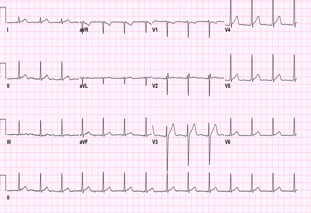 Ectopic Atrial Tachycardia Arrhythmias – Cardiovascular