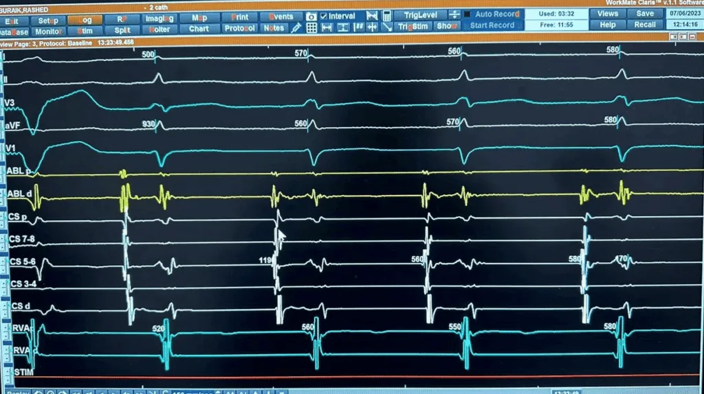 Ectopic Atrial Tachycardia Arrhythmias – Cardiovascular
