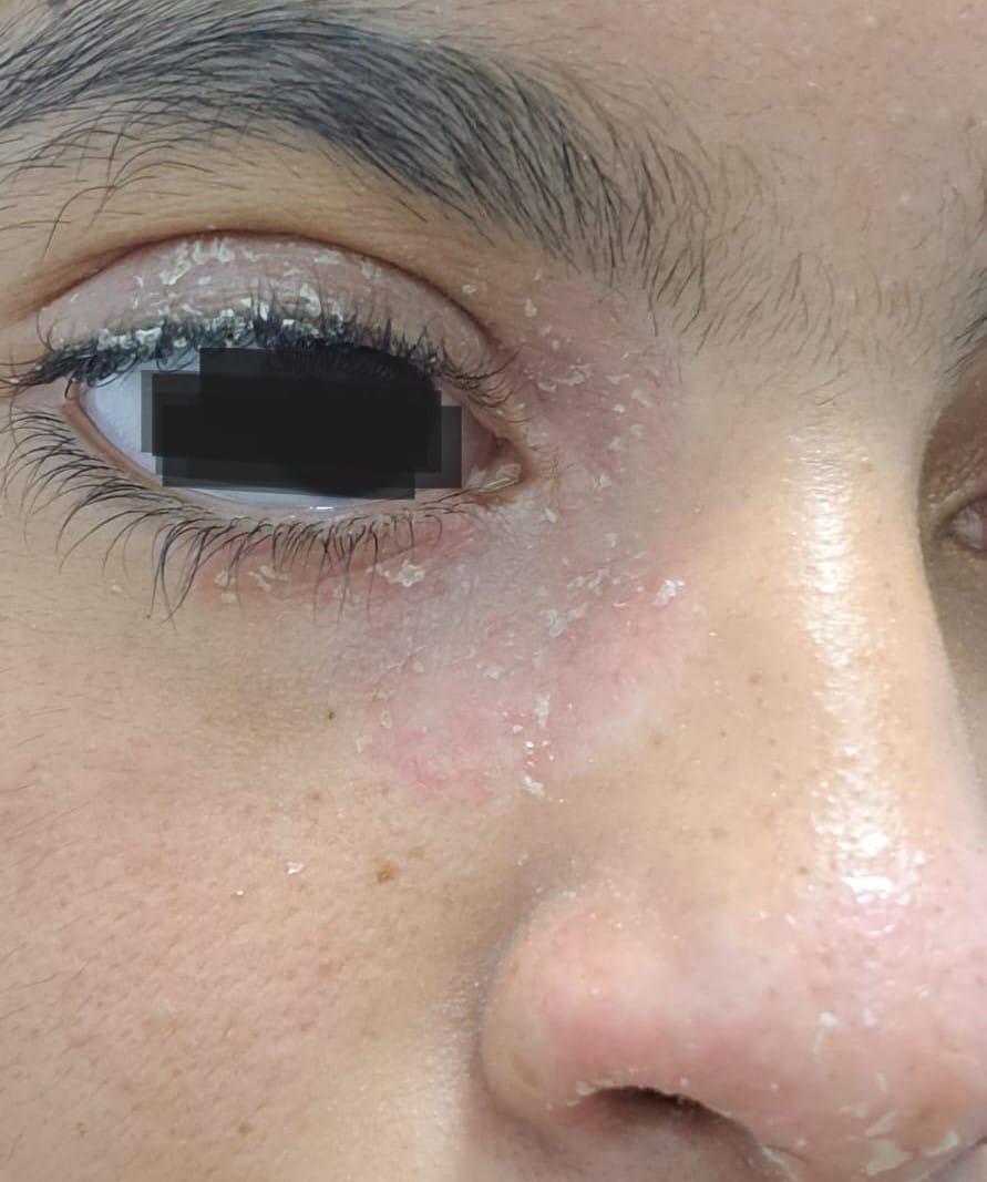 The Misleading Ocular Squamous Lesions - SeriesScience International ...