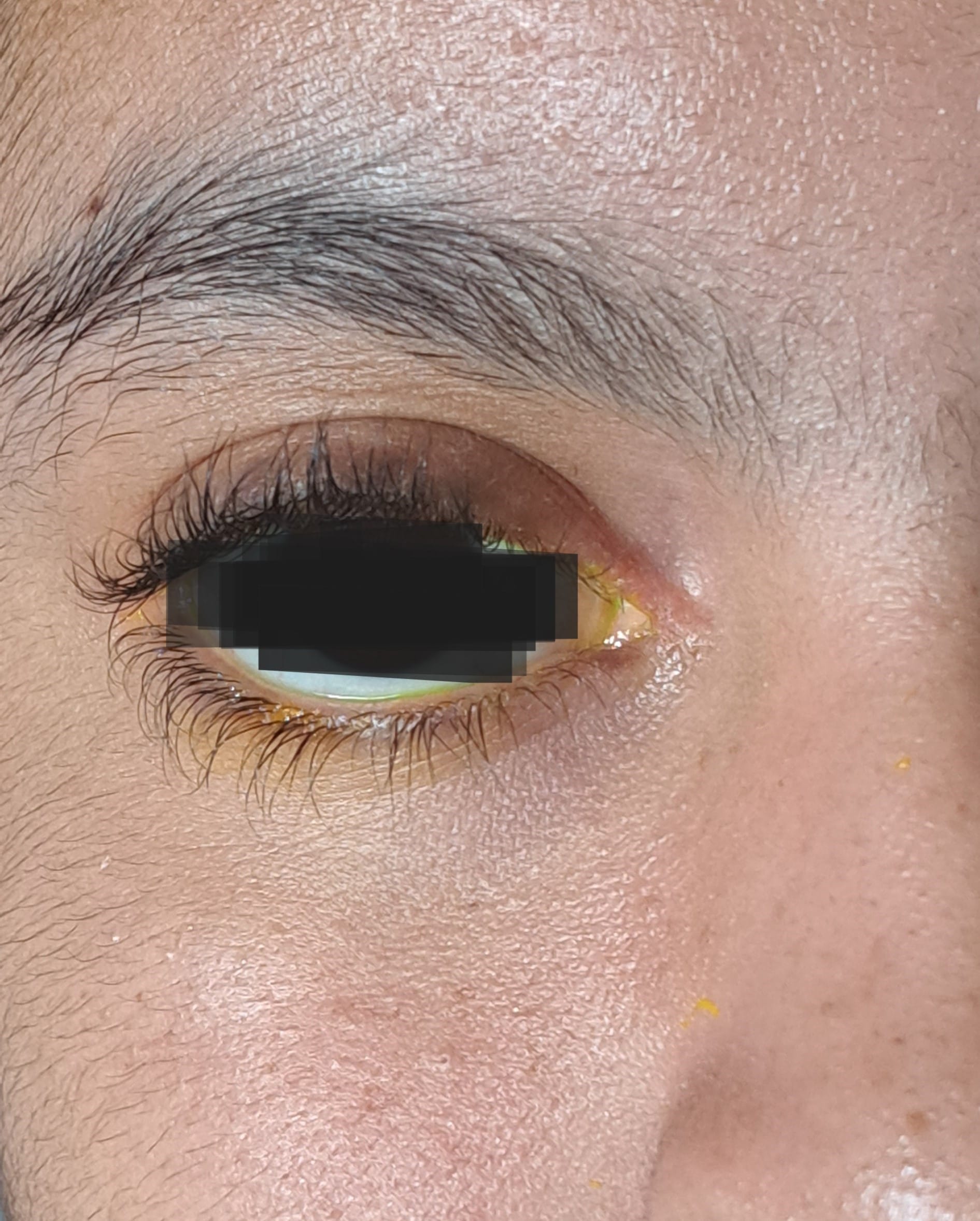The Misleading Ocular Squamous Lesions - SeriesScience International ...